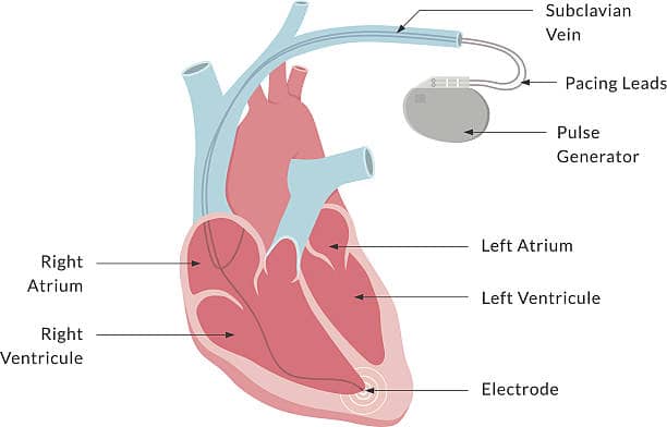 How do Pacemakers work? How do Pacemakers work?