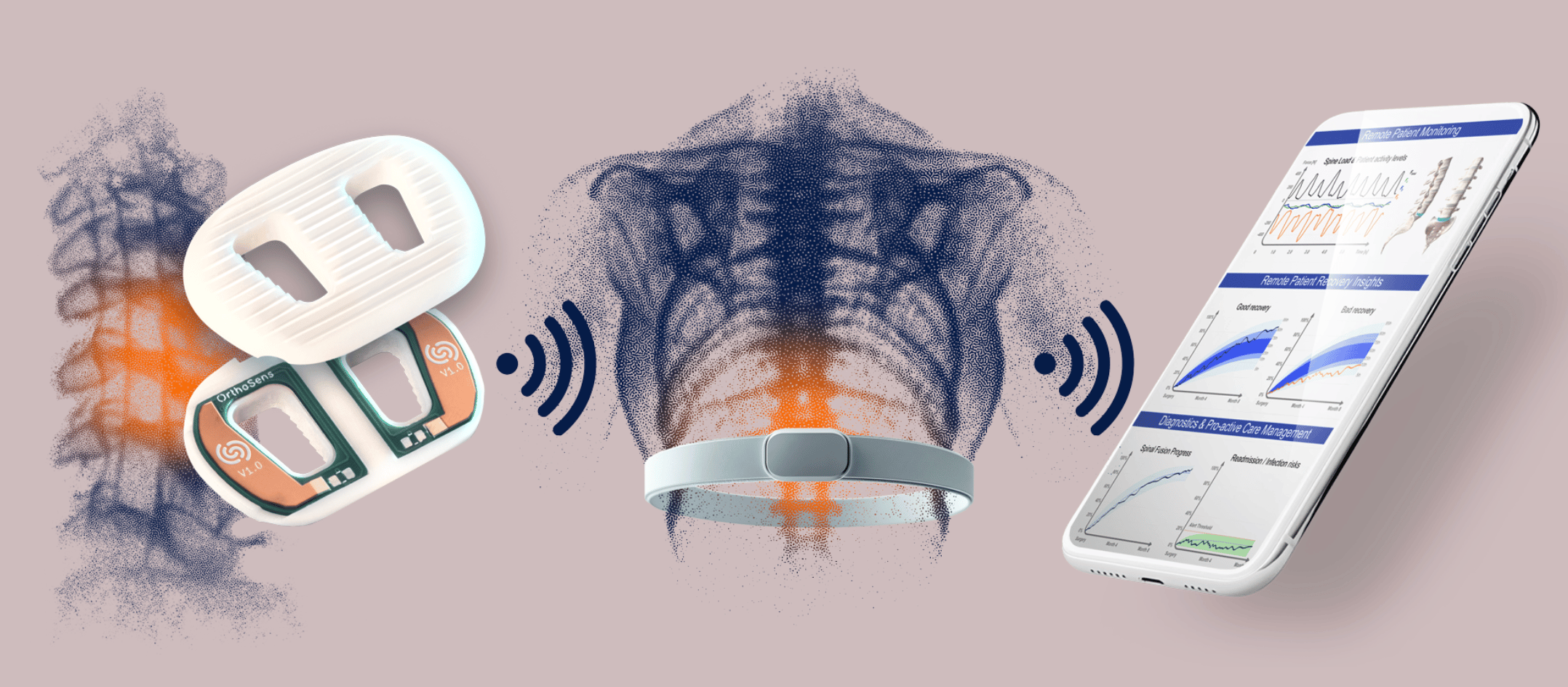 Pre-commercial startup bringing battery-free smart implants int ...